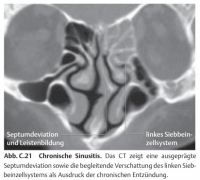 chronische Sinusitis (Nasennebenhöhlen-Entzündung) › Praxis für HNO ...